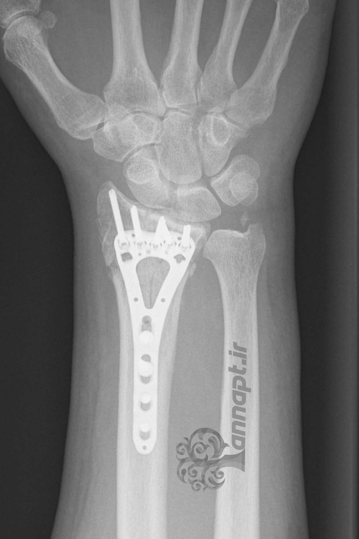 شکستگی مچ دست | شکستگی کالیس | Colles' fx